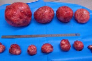 O que são os miomas? | Fetalmed Ultrassonografia Curitiba