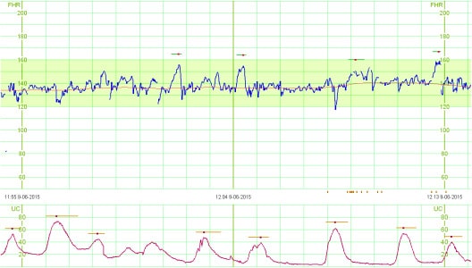 Cardiotocografia Anteparto | Fetalmed Medicina Fetal Curitiba