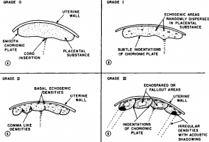 Desvendando o grau da placenta | Fetalmed - Medicina Fetal em Curitiba