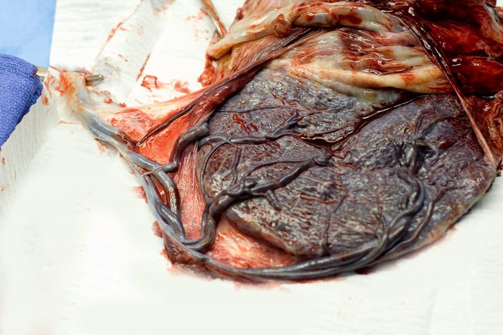 O que é Vasa Prévia? | Fetalmed Medicina Fetal Curitiba