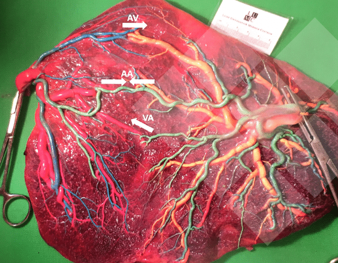 Sequência de Anemia-Policitemia em Gêmeos (TAPS) | Fetalmed Medicina Fetal