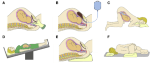O que é prolapso de cordão umbilical? | Fetalmed
