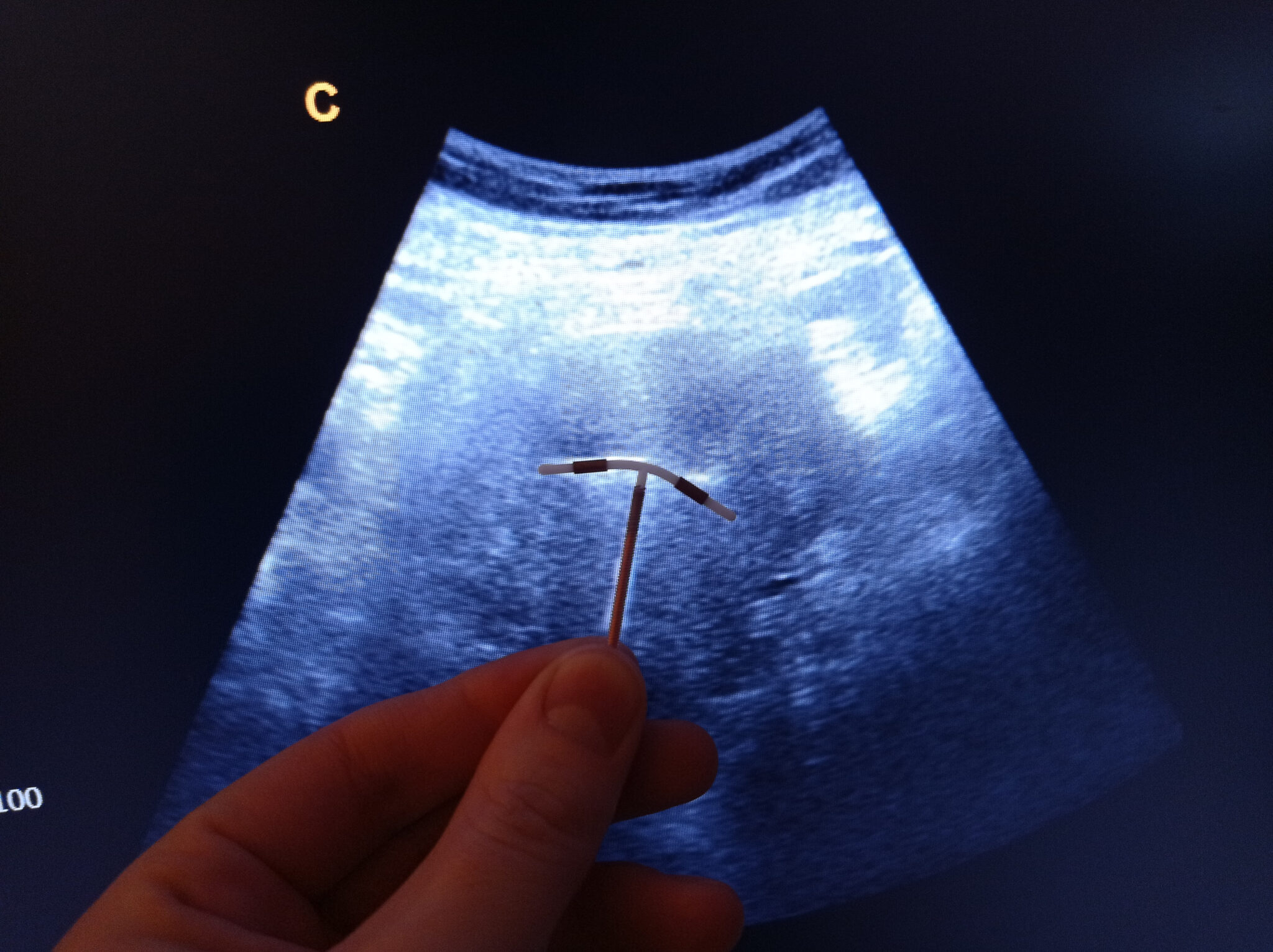 Deslocamento do DIU: Riscos e Cuidados | Fetalmed