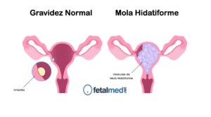 Tudo sobre Mola Hidatiforme | Fetalmed