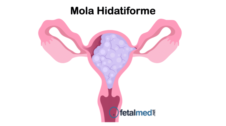 Tudo sobre Mola Hidatiforme | Fetalmed