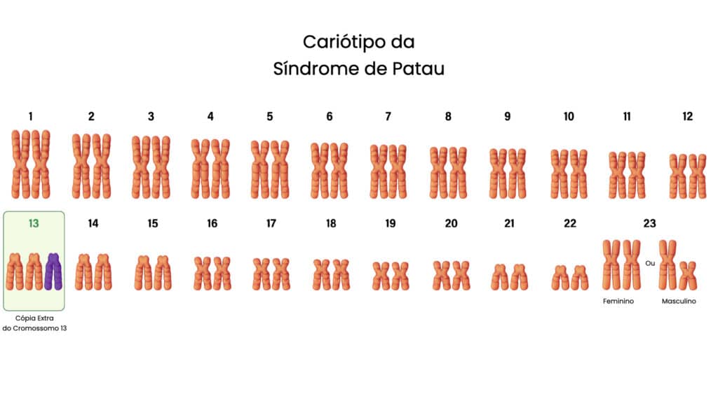 Síndrome de Patau: Sintomas, Diagnóstico e Tratamento da Trissomia 13 ...