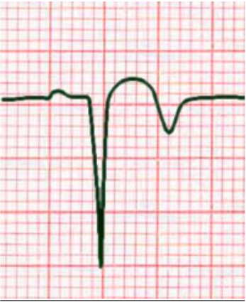 Inverted QRS - Cardiac Nursing - allnurses