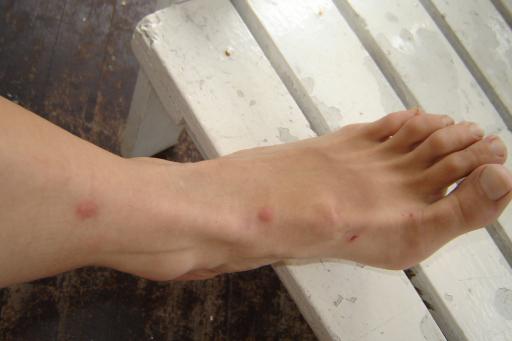 Vlooienbeten | Foto | Coschappen in Suriname