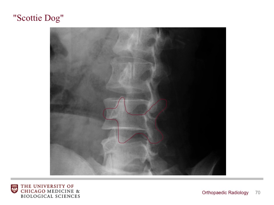 Spondylolisthesis X Ray Scotty Dog