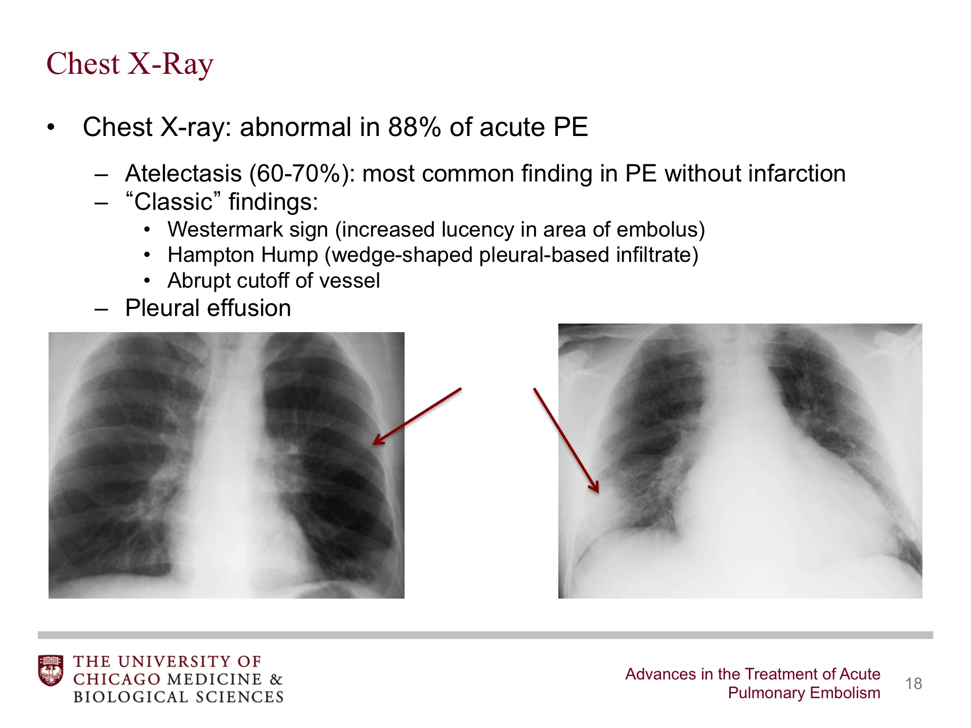 Pulmonary Infarction X Ray