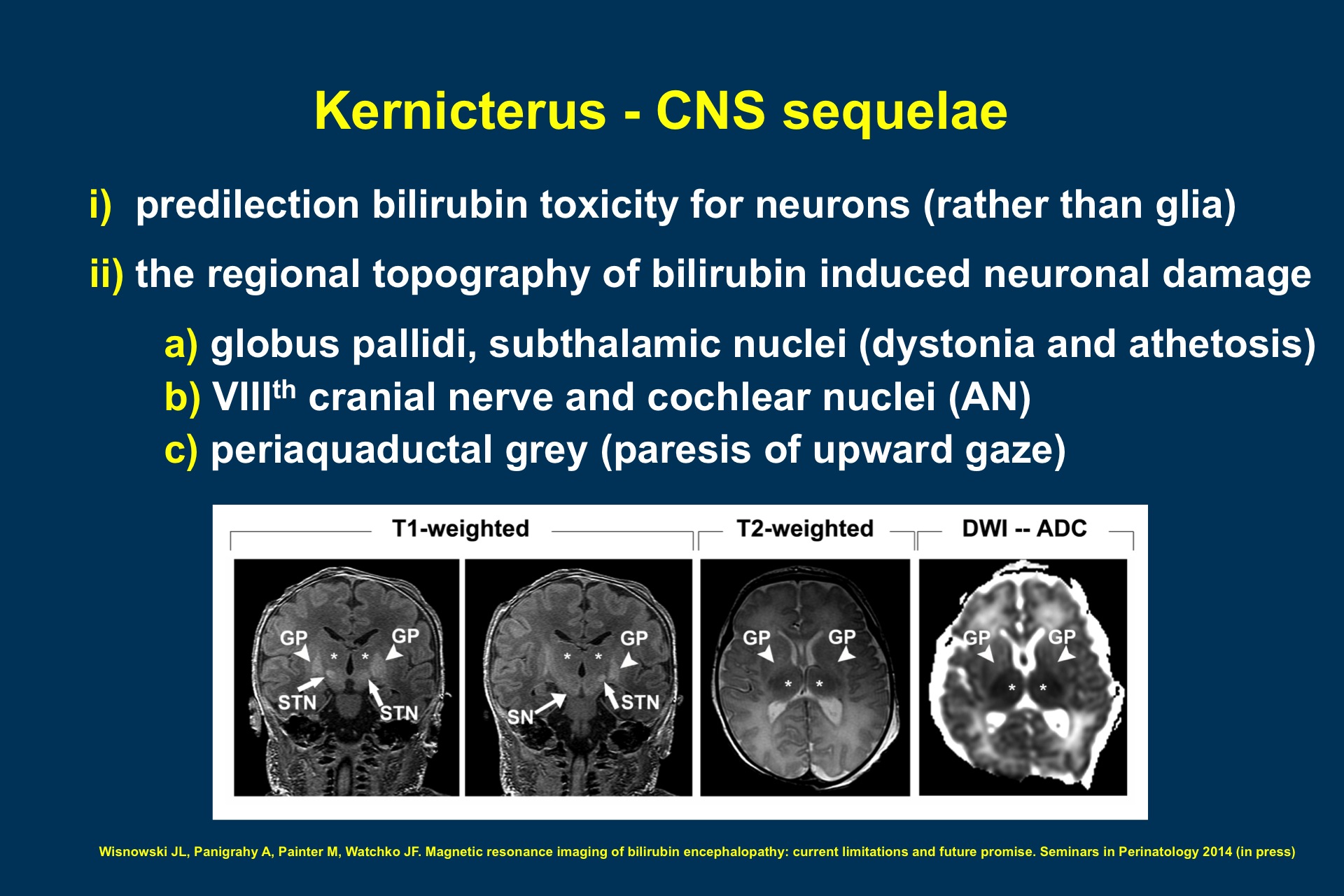 Kernicterus Mri