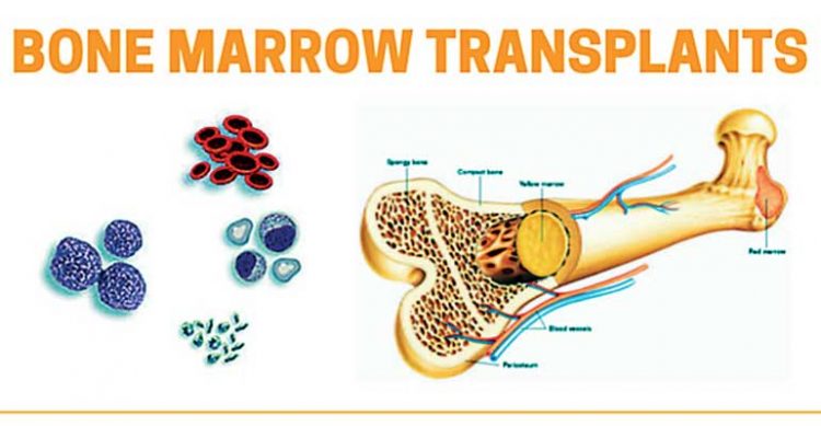 Reviving hope with Nawaloka Hospital's cutting-edge Bone Marrow ...