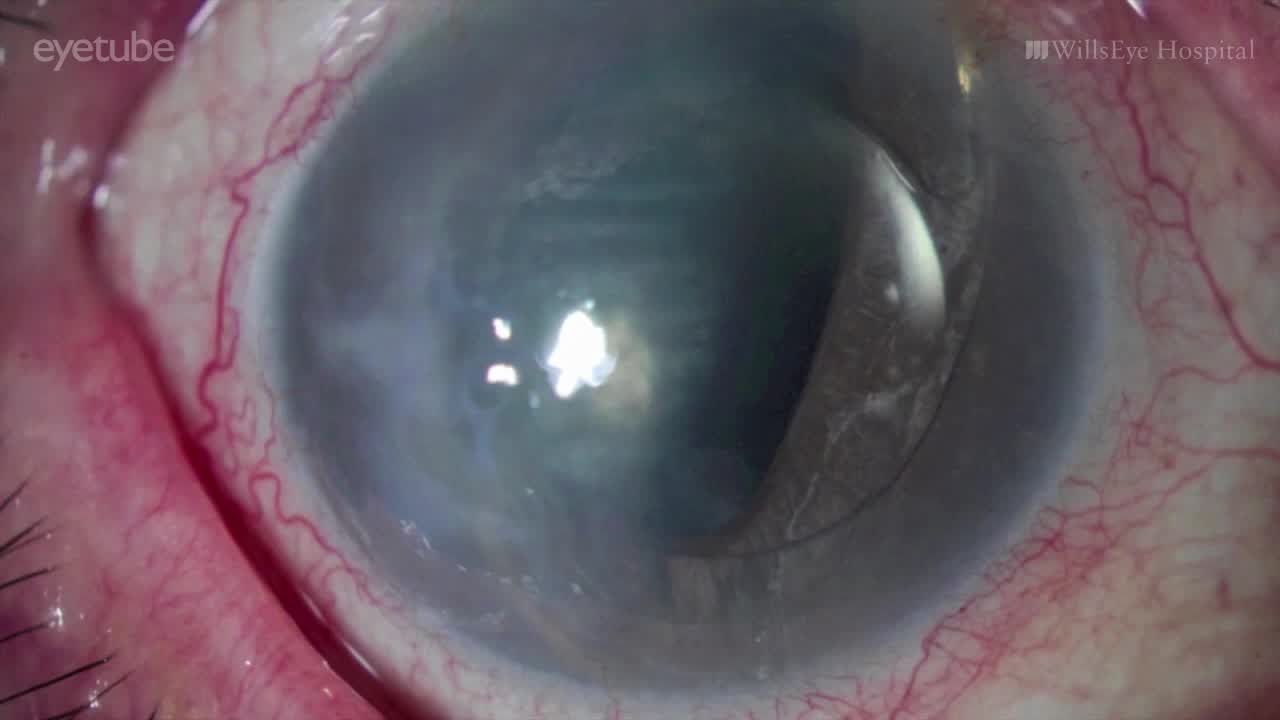 Inside the Wills Eye OR: Complications With an ACIOL - Eyetube