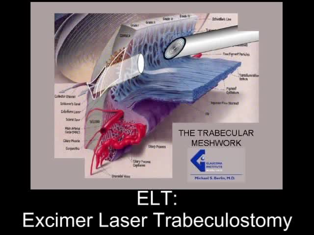 Excimer Laser Trabeculostomy (ELT) - Eyetube