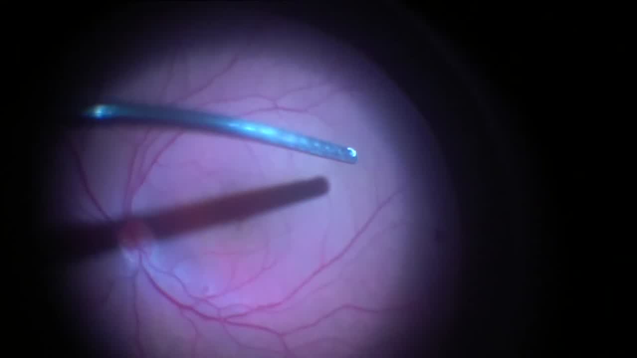 Vitrectomy for Traumatic Lens Dislocation With Perfluorocarbon Liquid ...