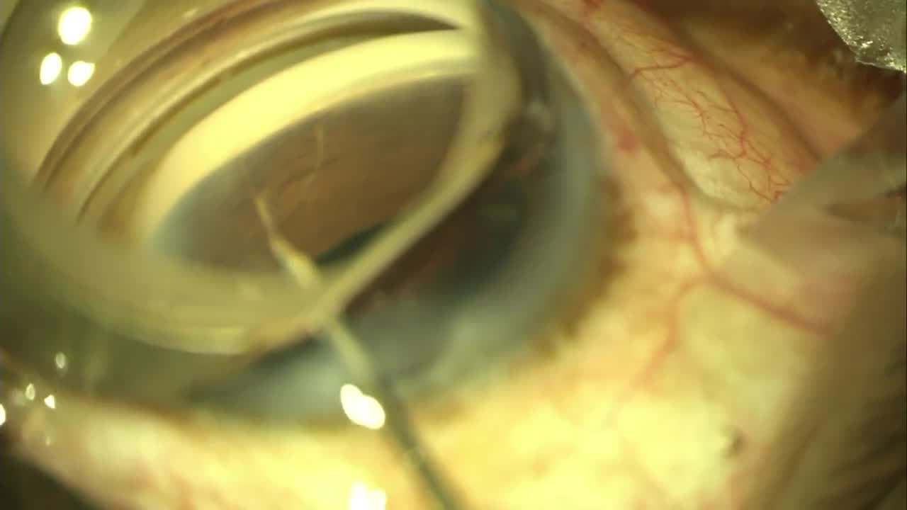 Goniotomy with KDB - Eyetube