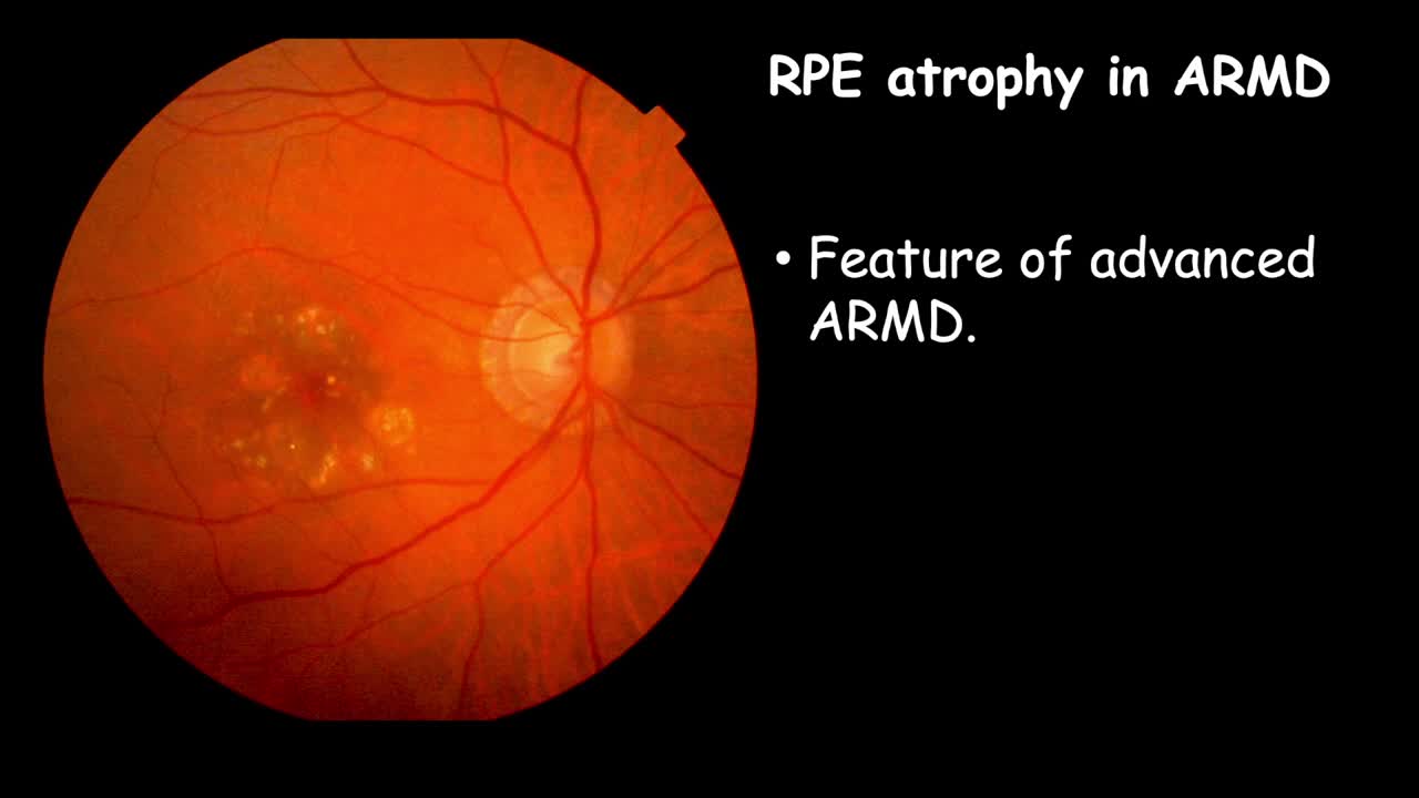 Clinical Changes in RPE: Drusen - Eyetube