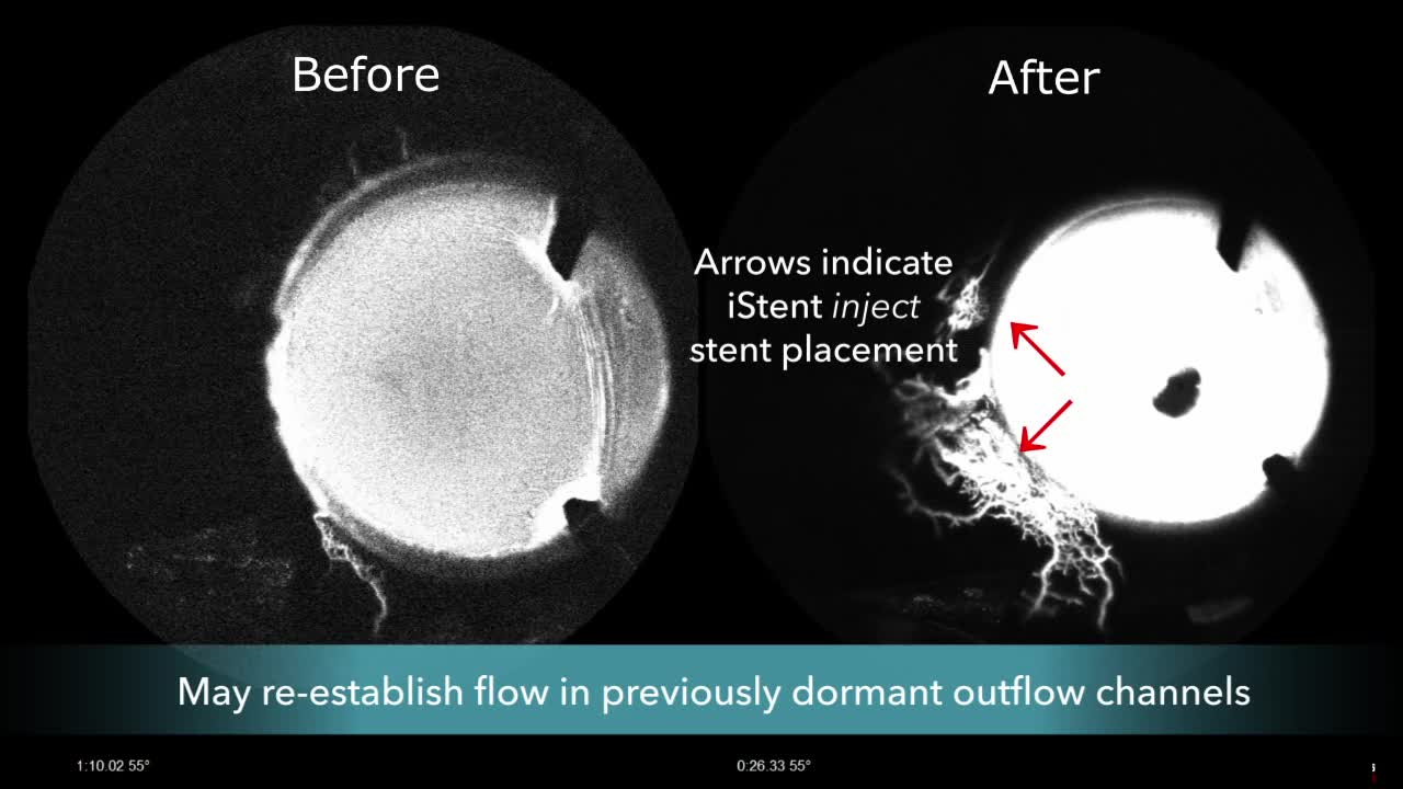 The Importance of the Trabecular Meshwork - Eyetube