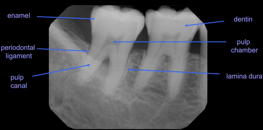 Radiographic Anatomy of Deciduous and Permanent Teeth & Eruption ...