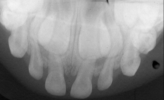 Radiographic Anatomy of Deciduous and Permanent Teeth & Eruption ...