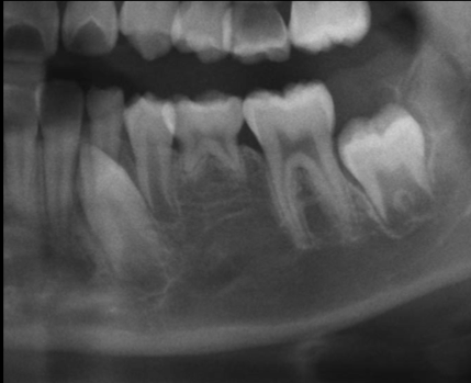 Radiographic Anatomy of Deciduous and Permanent Teeth & Eruption ...