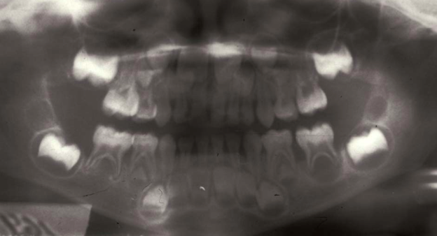 Radiographic Anatomy of Deciduous and Permanent Teeth & Eruption ...