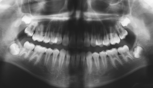 Radiographic Anatomy of Deciduous and Permanent Teeth & Eruption ...
