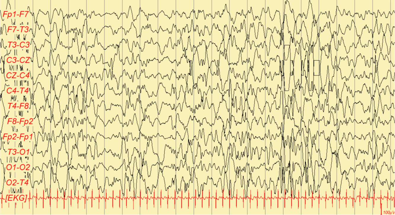 CLTM - Board Prep Flashcards by Anthony R. Cockrell, CET, RPSGT, R. EEG ...