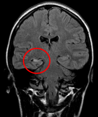 CLTM - Board Prep Flashcards by Anthony R. Cockrell, CET, RPSGT, R. EEG ...
