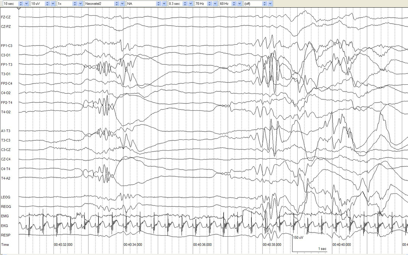 CLTM - Board Prep Flashcards by Anthony R. Cockrell, CET, RPSGT, R. EEG ...