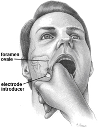 CLTM - Board Prep Flashcards by Anthony R. Cockrell, CET, RPSGT, R. EEG ...