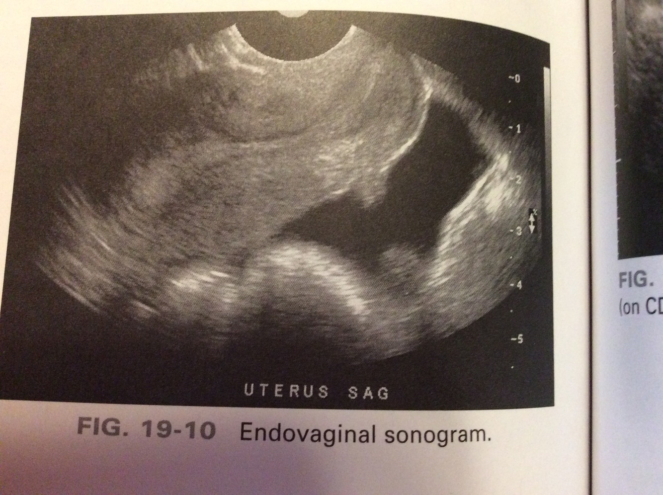 Space Of Retzius Ultrasound