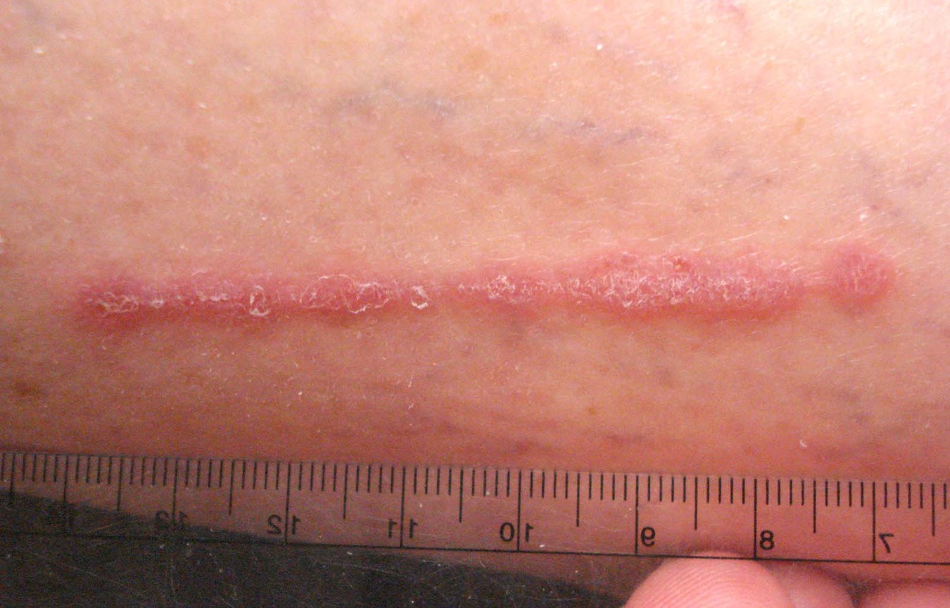 DESCRIBING SKIN LESIONS AND RASHES Flashcards by Alex Kinsky | Brainscape