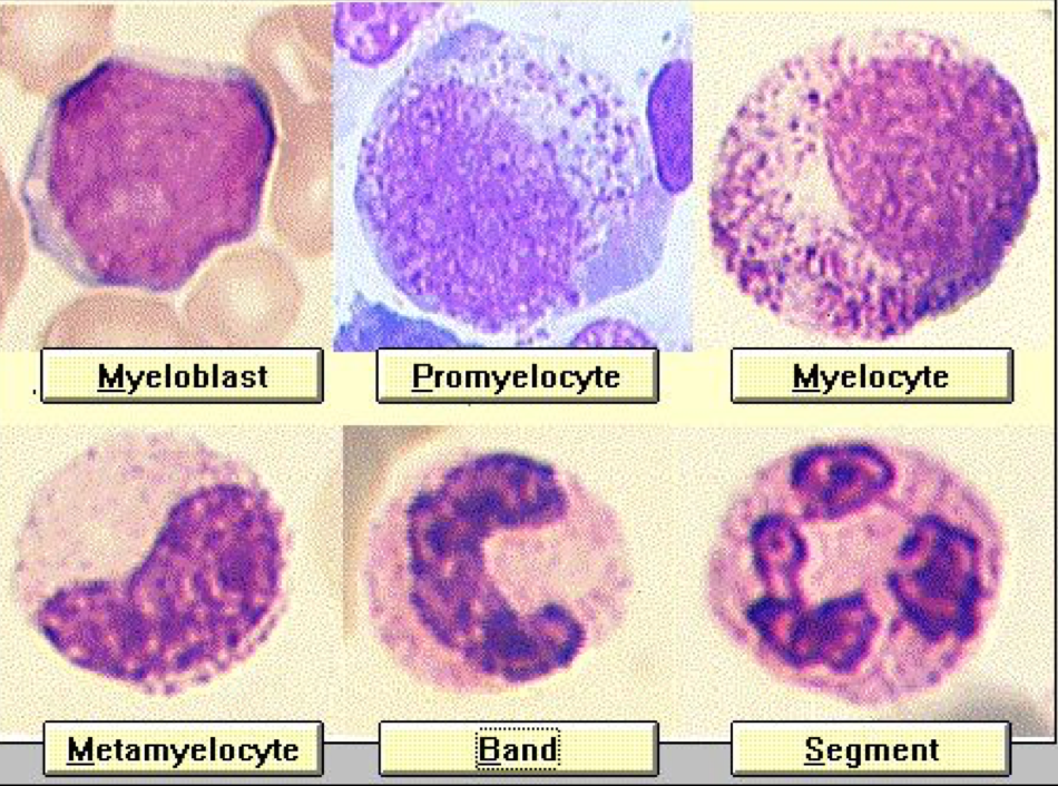 Metamyelocytes And Myelocytes