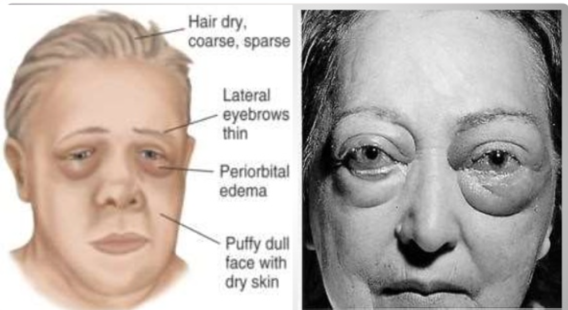 Periorbital Edema Hypothyroidism