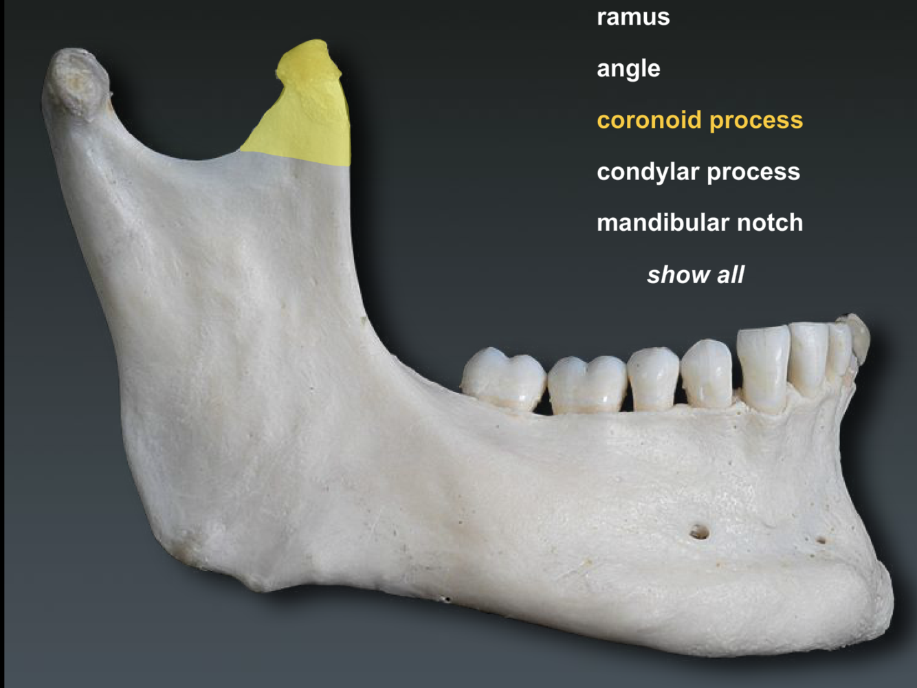 Coronoid Fossa Mandible