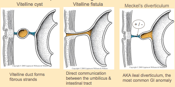 Vitelline Fistula