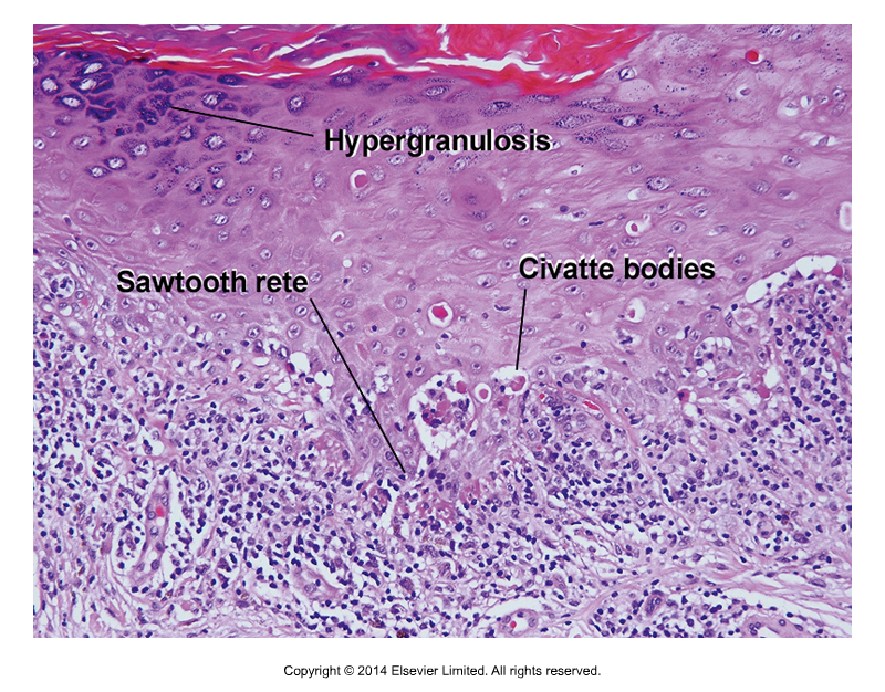 Lichen Planus Histology Civatte Body