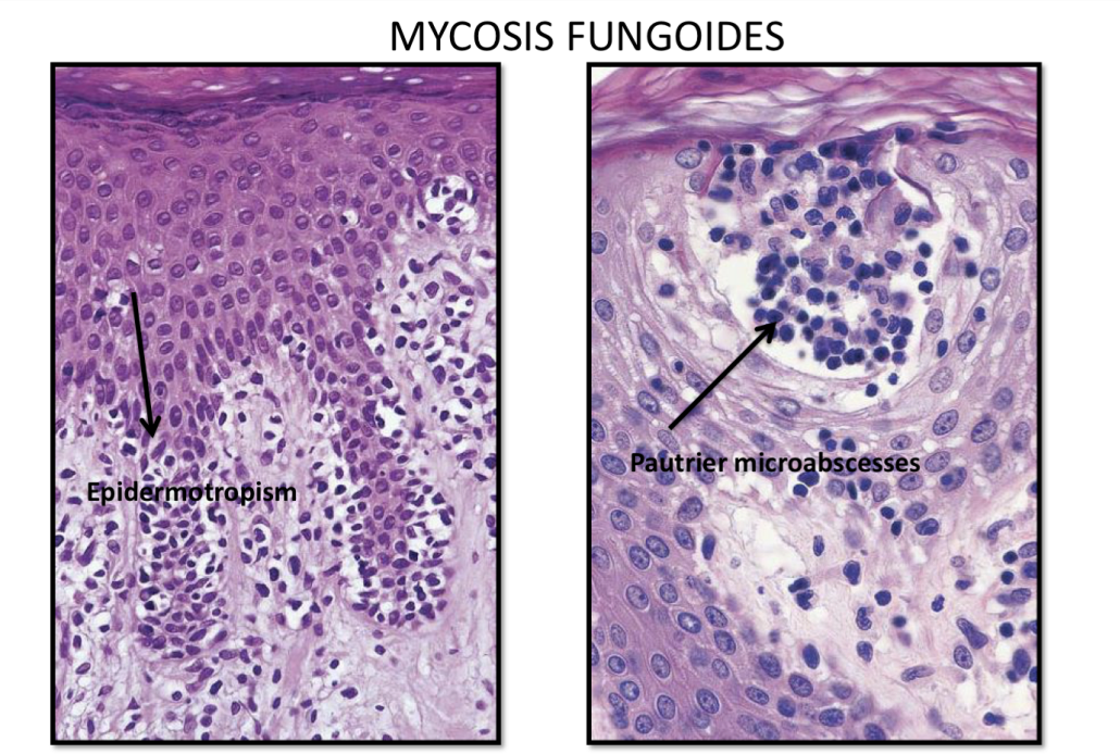 Pautrier Microabscesses