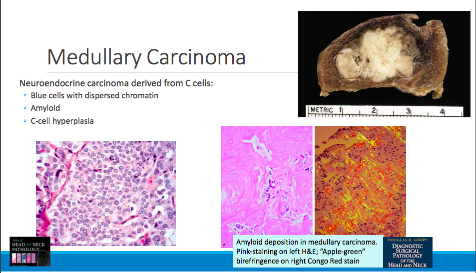 Pretibial Myxedema Pathology