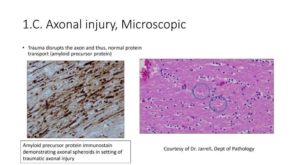 Diffuse Axonal Injury Histology