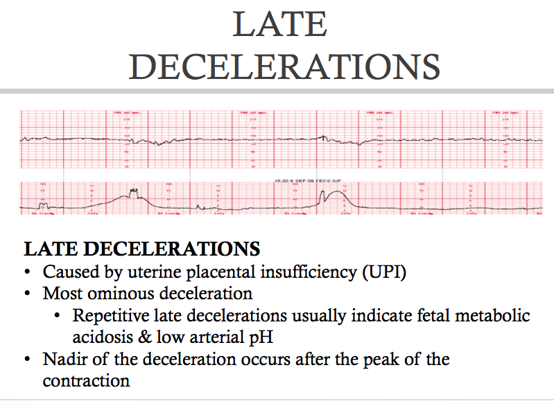 Late Decelerations