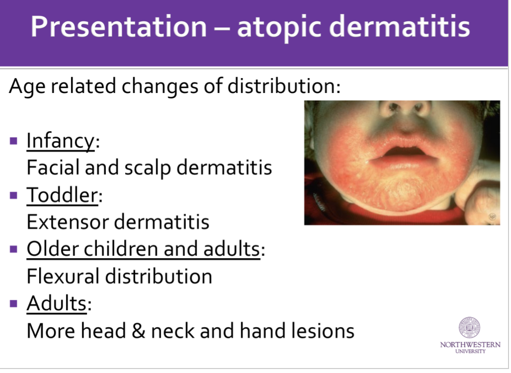Childhood Eczema Distribution
