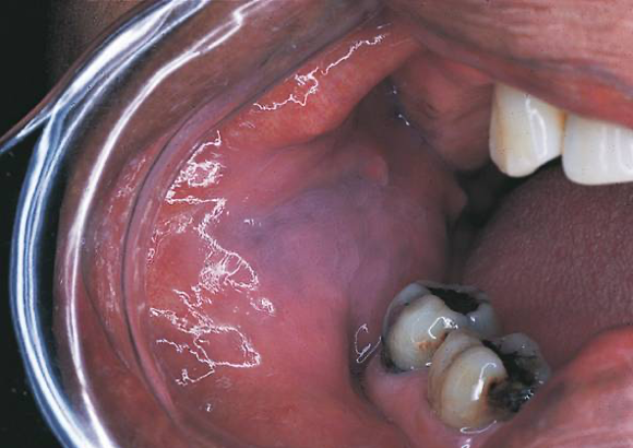 Chapter 1 - Diagnosis of Oral Lesions Flashcards by Jesse Rennie ...