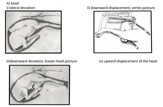 40. Definition of the presentation, position, and posture of the foetus ...