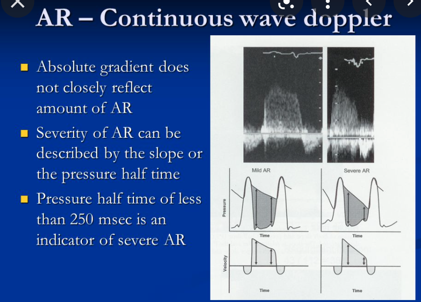 Valvular Heart Disease (VHD): AR/AS Flashcards by Yoshiko Peterson ...
