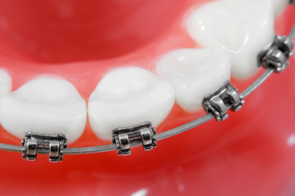 Broken Braces? Here's What You Need To Know - Reddick Orthodontics