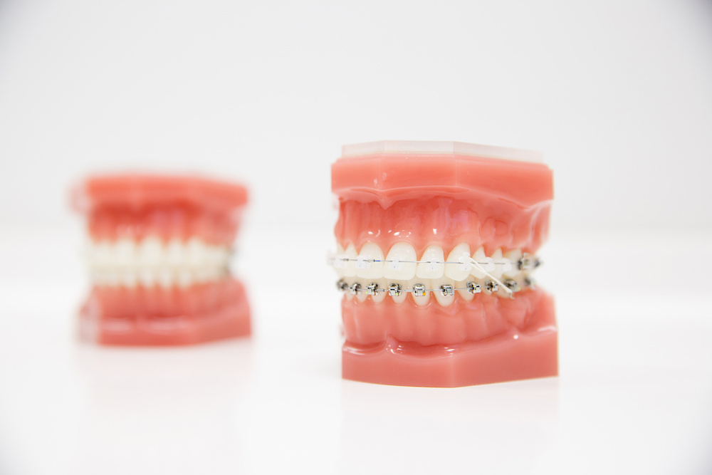 Types and Classes of Malocclusion - Reddick Orthodontics