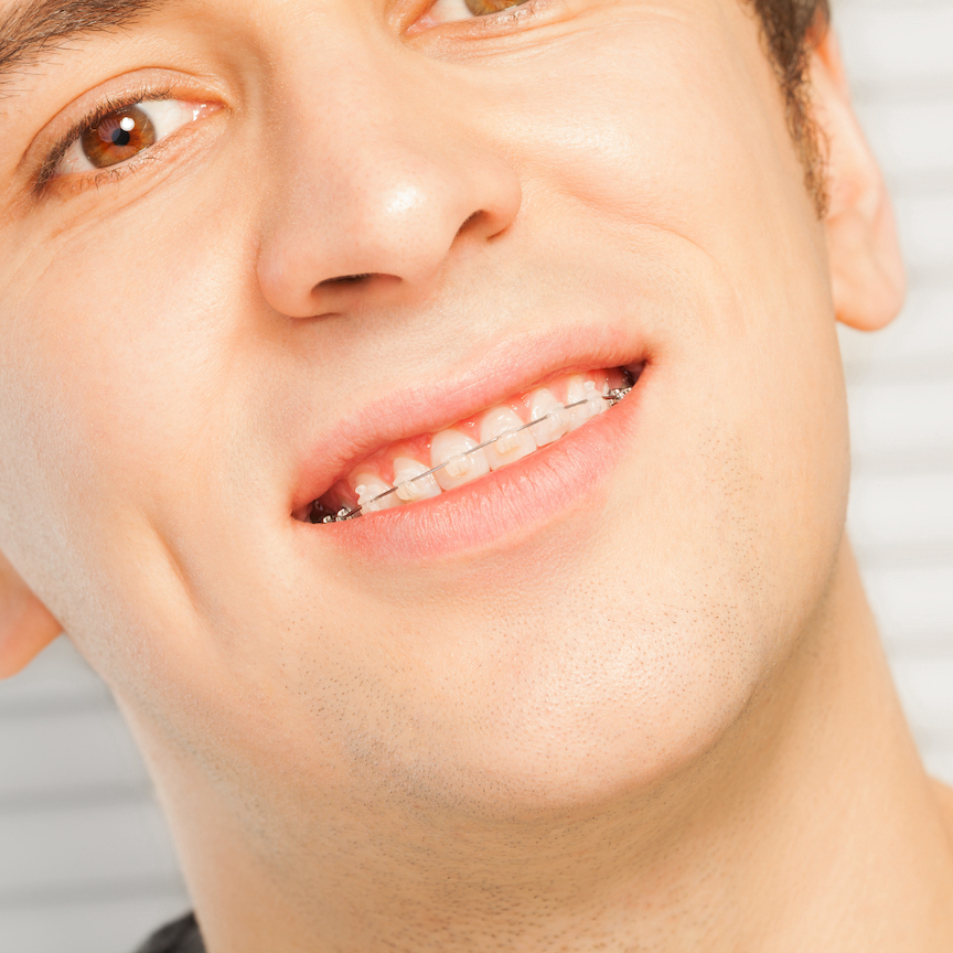 Clear Ceramic Braces - Reddick Orthodontics - Educational