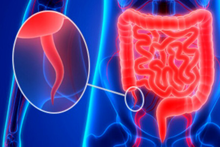Que es Apendicitis | Consejos de Salud